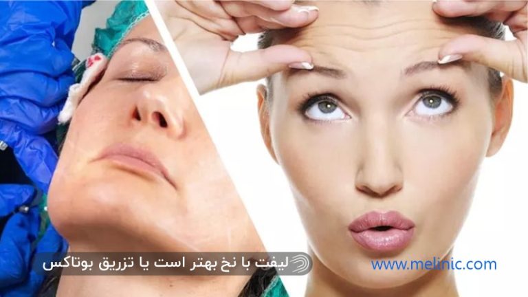 لیفت با نخ بهتر است یا تزریق بوتاکس [مقایسه کامل] | ملینیک