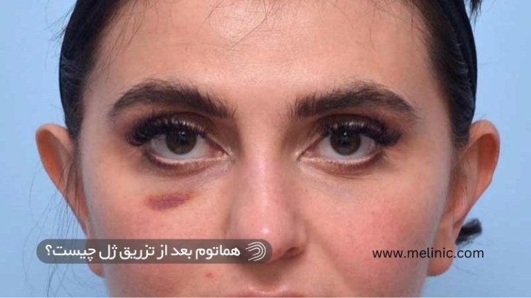 علت هماتوم بعد از تزریق ژل + روش درمان | ملینیک
